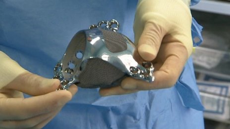 Patient has 3D-printed hip replacement in Southampton - Highland Radio ...